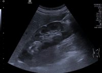 Normal kidney – Atlas of Ultrasound