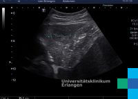 Angiosarkom – Sonographieatlas Erlangen