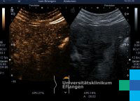 Angiosarkom – Sonographieatlas Erlangen