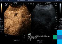 Angiosarkom – Sonographieatlas Erlangen
