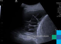 Rib fracture – Atlas of Ultrasound