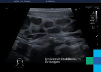 Lymph nodes – Atlas of Ultrasound