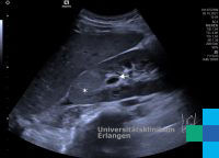 Pyelonephritis – Atlas of Ultrasound