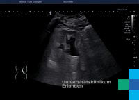 Harnstau – Sonographieatlas Erlangen