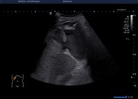 Gallbladder perforation – Atlas of Ultrasound