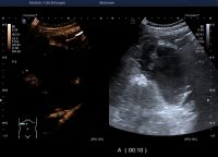 Gallbladder perforation – Atlas of Ultrasound