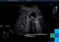 Akute Cholezystitis – Sonographieatlas Erlangen