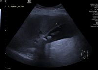 Gallbladder stones – Atlas of Ultrasound