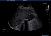 Gallbladder stones – Atlas of Ultrasound
