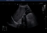 Gallbladder stones – Atlas of Ultrasound