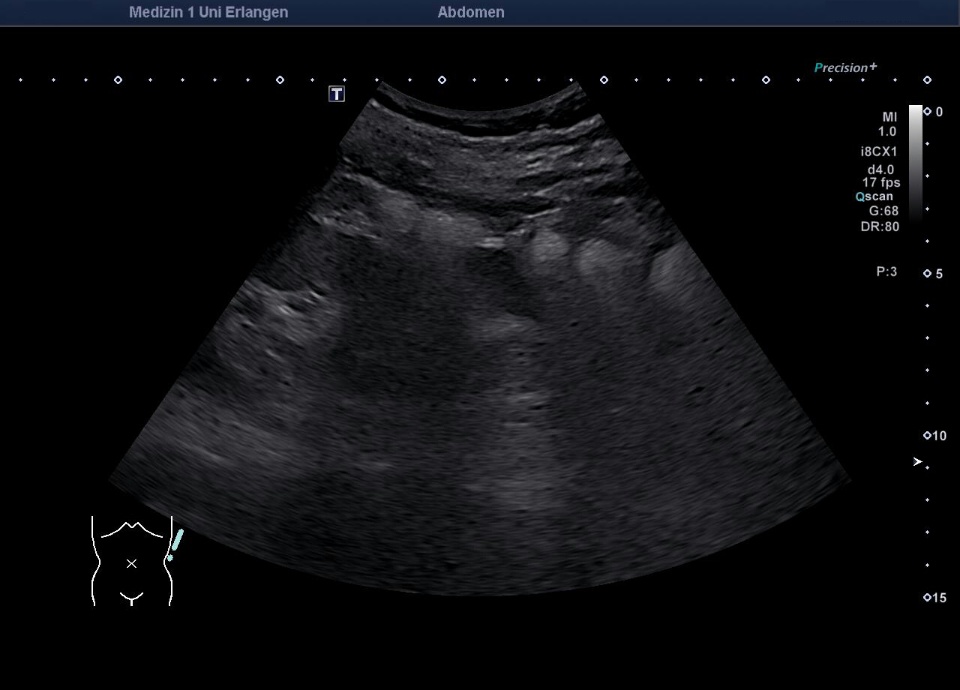 Normal kidney – Atlas of Ultrasound
