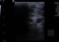 Thyroid cyst – Atlas of Ultrasound
