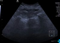 Blasentumore – Sonographieatlas Erlangen