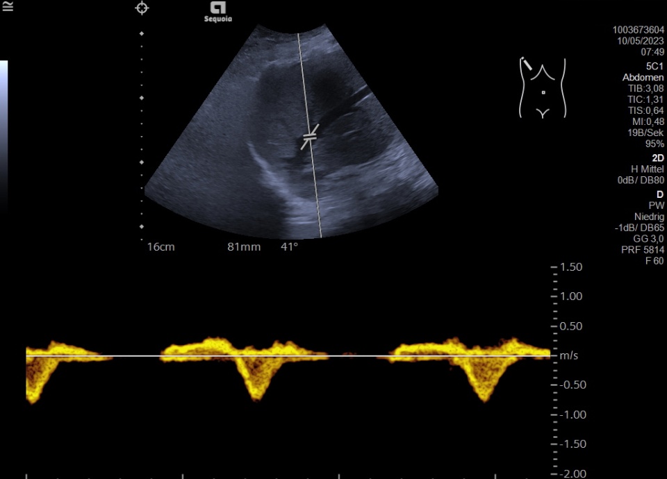 Right heart failure – Atlas of Ultrasound