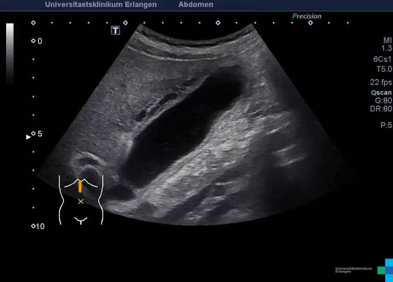 Pathologien Gallenblase – Sonographieatlas Erlangen
