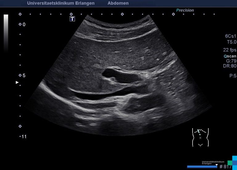 Normalbefunde Gallenwege, Leberpforte – Sonographieatlas Erlangen