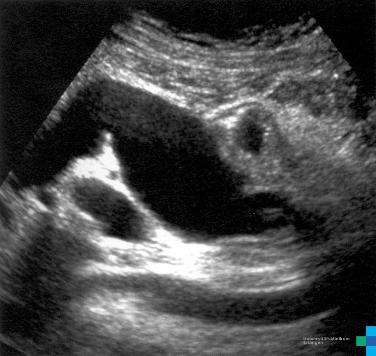 Pathologien Gallenwege, Leberpforte – Sonographieatlas Erlangen
