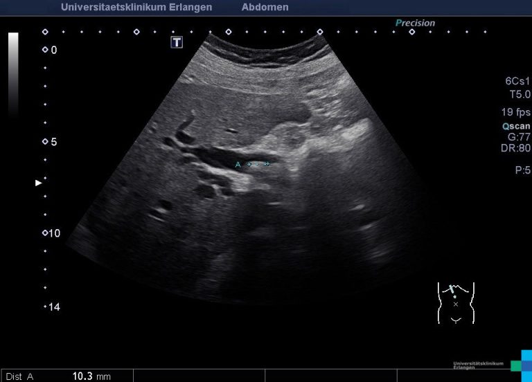 Pathologien Gallenwege, Leberpforte – Sonographieatlas Erlangen