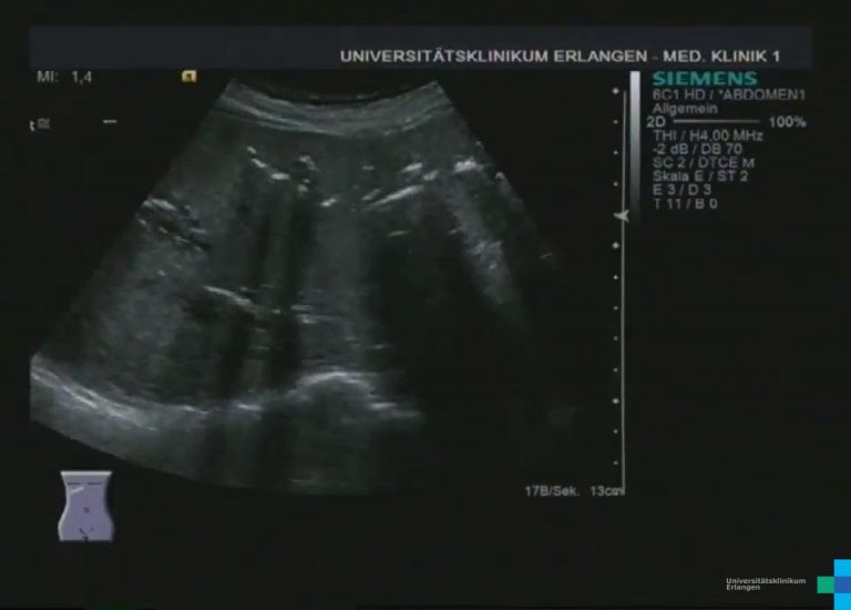 Pathologien Gallenwege, Leberpforte – Sonographieatlas Erlangen