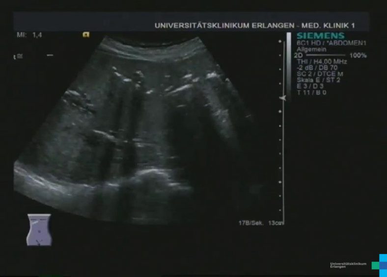 Pathologien Gallenwege, Leberpforte – Sonographieatlas Erlangen