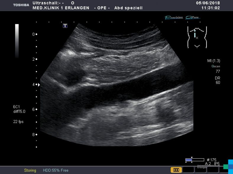 Normalbefunde Pankreas – Sonographieatlas Erlangen
