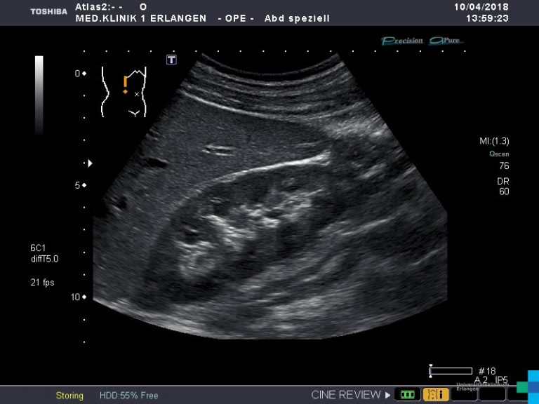 Normalbefunde Nieren – Sonographieatlas Erlangen