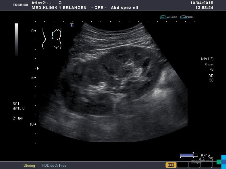 Normalbefunde Nieren – Sonographieatlas Erlangen