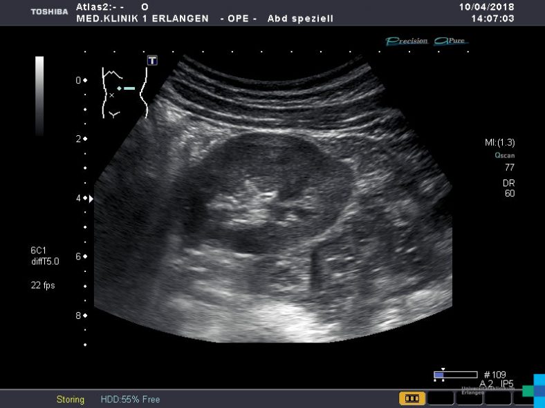 Normalbefunde Nieren – Sonographieatlas Erlangen