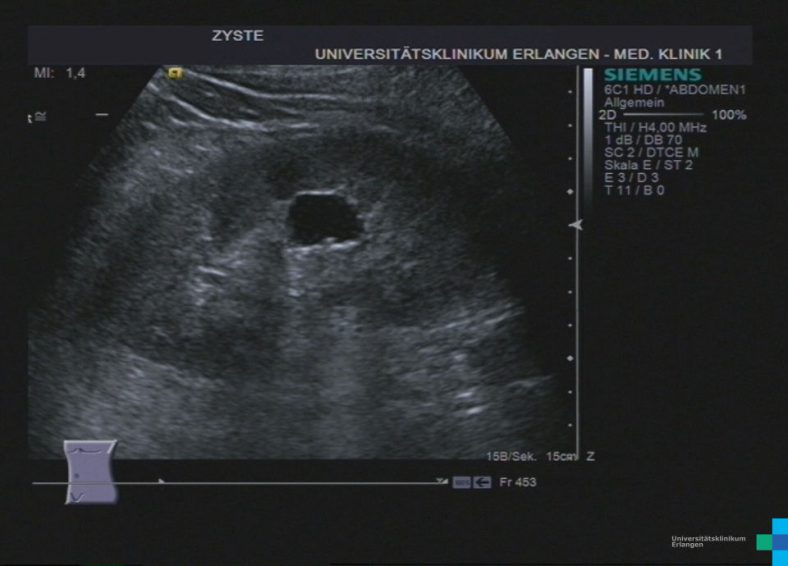 Pathologien Niere – Sonographieatlas Erlangen