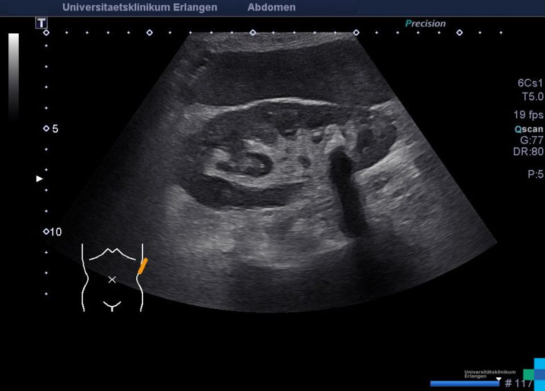 Pathologien Niere – Sonographieatlas Erlangen