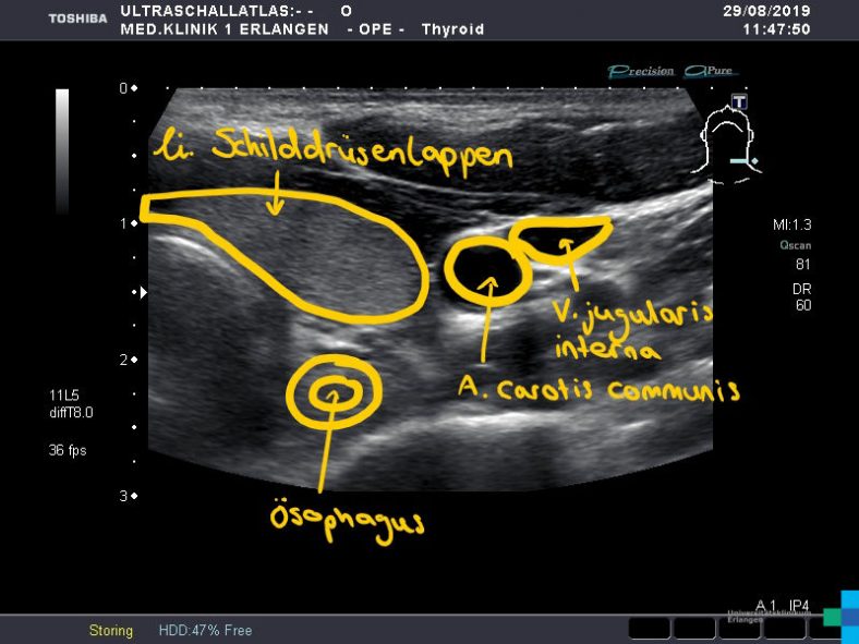Untersuchungsablauf Schilddrüse – Sonographieatlas Erlangen