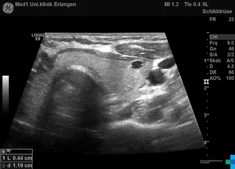 Pathologien Schilddrüse – Sonographieatlas Erlangen