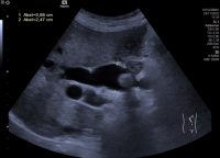 Cholestasis – Atlas of Ultrasound