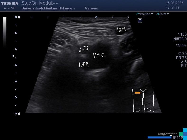 Thrombosediagnostik Oberschenkel – Sonographieatlas Erlangen