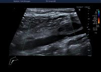 Beinvenenthrombose – Sonographieatlas Erlangen