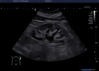 Harnstau – Sonographieatlas Erlangen