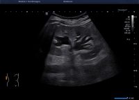 Harnstau – Sonographieatlas Erlangen