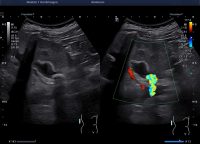 Harnstau – Sonographieatlas Erlangen