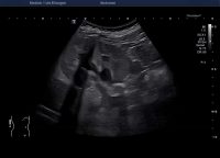 Harnstau – Sonographieatlas Erlangen