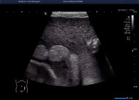 Peritonealkarzinose – Sonographieatlas Erlangen