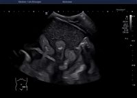 Peritonealkarzinose – Sonographieatlas Erlangen