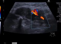 Punktion Gl. submandibularis – Sonographieatlas Erlangen