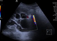 Harnstau – Sonographieatlas Erlangen