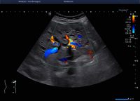 Cholestasis – Atlas of Ultrasound