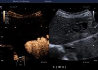 Complex liver cyst (series of images) – Atlas of Ultrasound