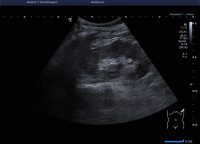 Pyelonephritis – Atlas of Ultrasound