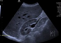 Harnstau – Sonographieatlas Erlangen