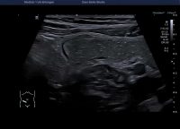 Normal small intestine – Atlas of Ultrasound