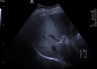 Focal fatty infiltration – Atlas of Ultrasound