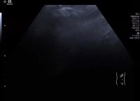 Focal fatty infiltration – Atlas of Ultrasound